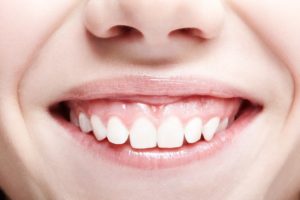Gum Overgrowth Causes and Treatments Conway | American Dental Care